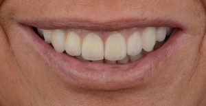 ¿Qué es la prostodoncia? ¿Qué hace un prostodoncista?