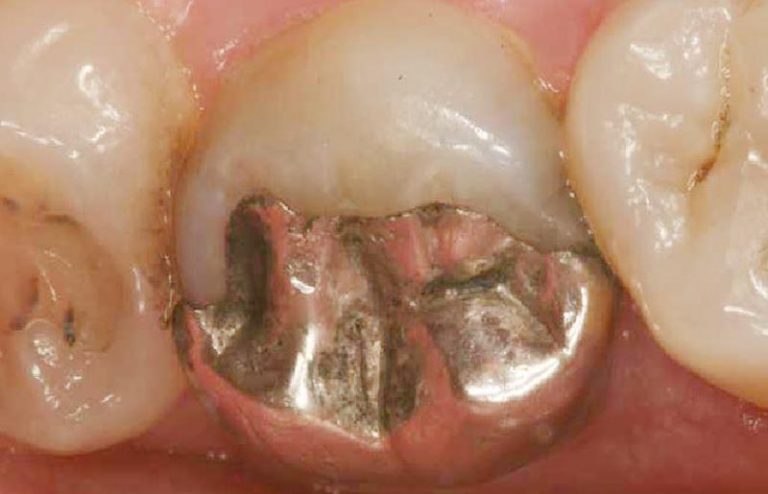 Amalgama dental, ¿qué es y para qué se utiliza? | BQDC