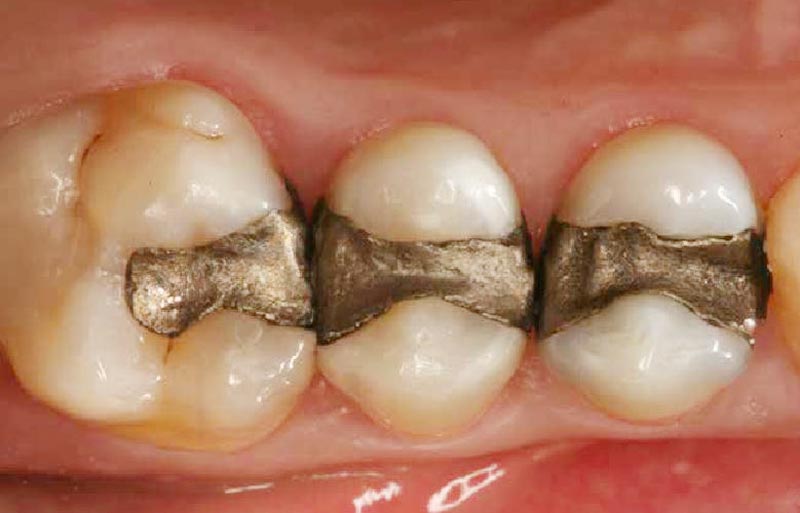Amalgama dental, ¿qué es y para qué se utiliza? | BQDC