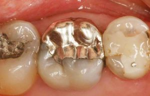 Amalgama dental, ¿qué es y para qué se utiliza? | BQDC