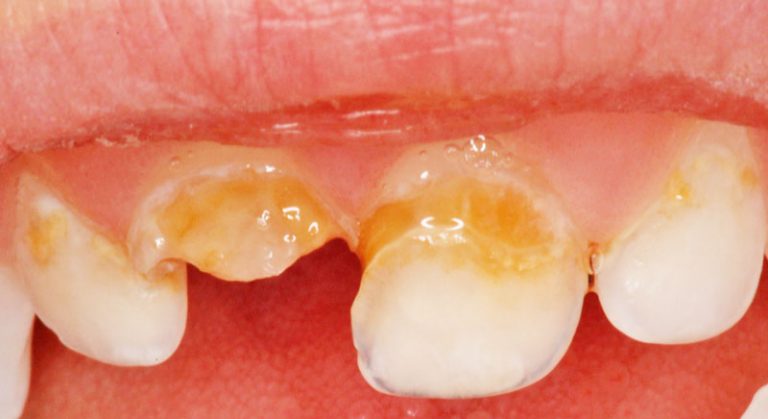 ¿Qué es la caries del biberón? | Salud dental infantil • BQDC