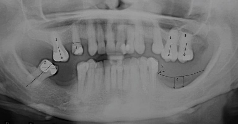 ¿Qué es el edentulismo? Soluciones a la pérdida de dientes