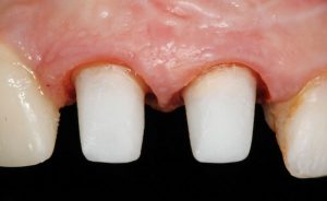 ¿Que es un perno muñón / poste intraradicular? • BQDC