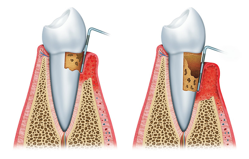 ¿Qué es la periodontitis? - Glosario Odontológico | BQDC