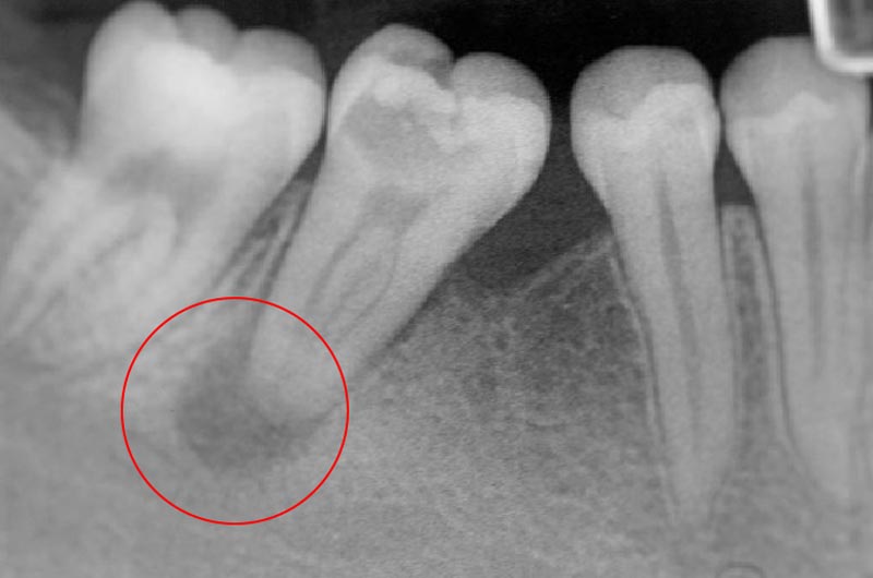 Absceso dental Qué es, causas y tratamiento | BQDC