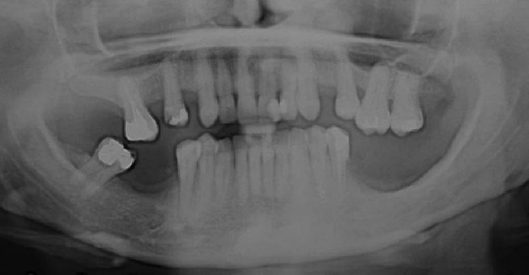 ¿Qué es el edentulismo y cómo se puede solucionar? | BQDC